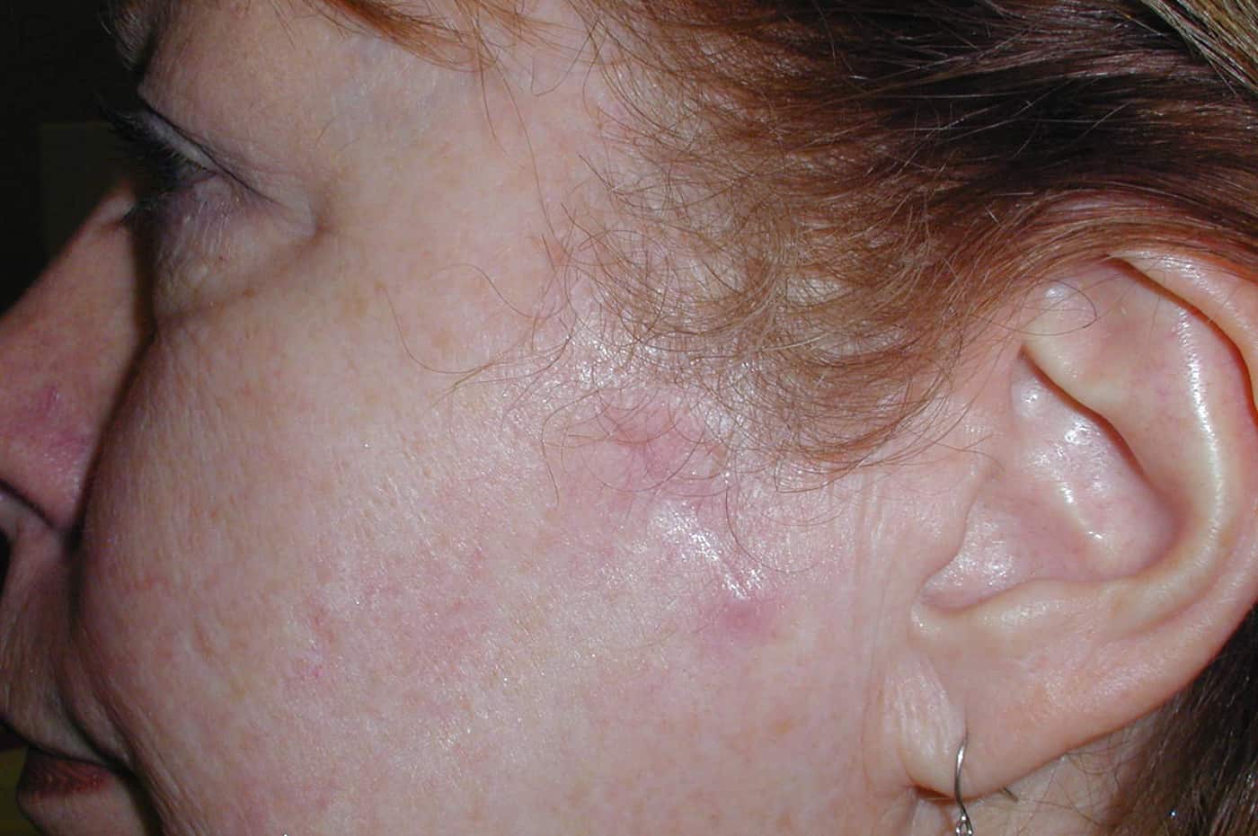 Skincancer cheek 501a Janjua Facial Surgery Skincancer cheek 501a Janjua Facial Surgery